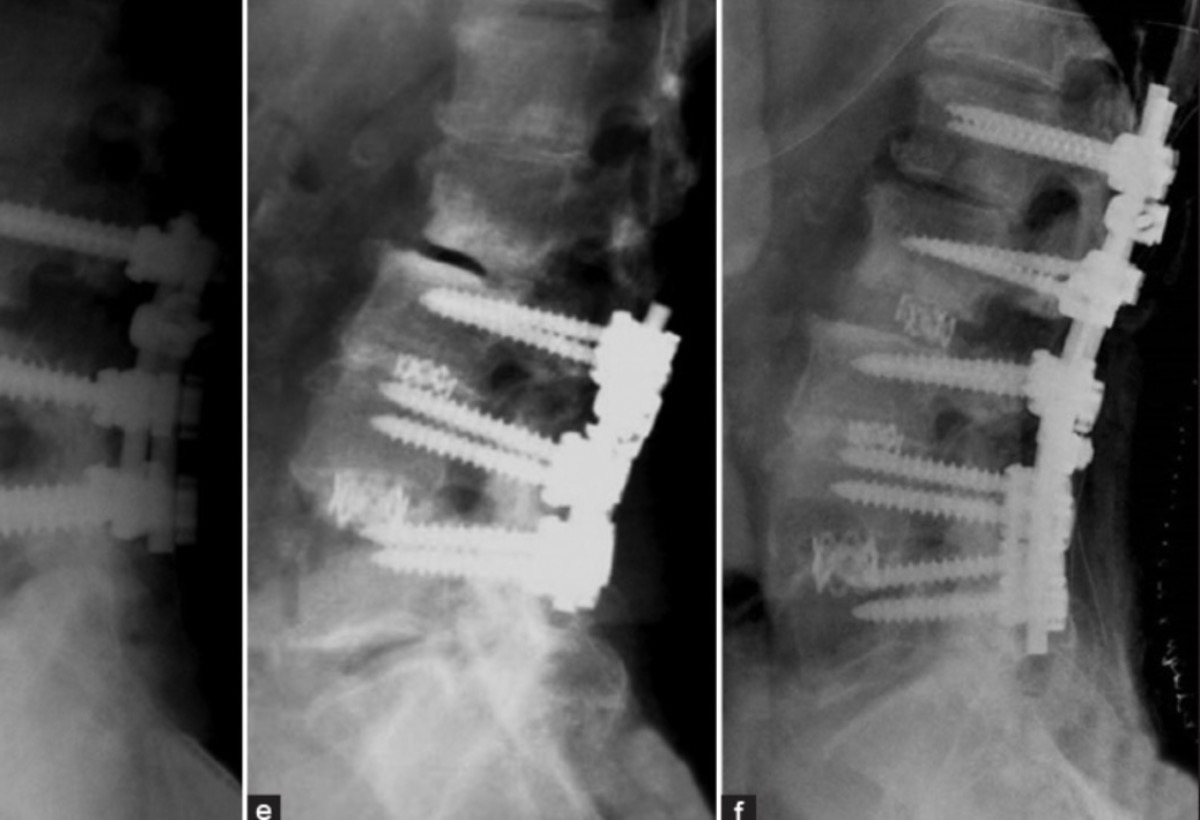 *NeedLowerDiscSurgeryASAP - Fundraiser by Chris Ivie on *spotfund