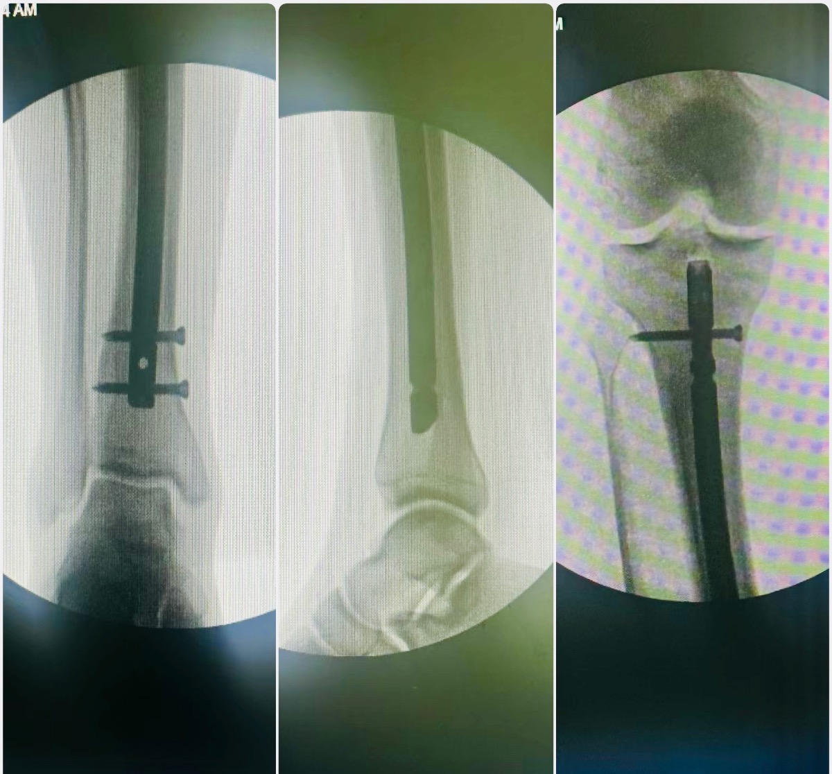 *MedicalForSethsBrokenLeg - Fundraiser by Jess McWilliams on *spotfund